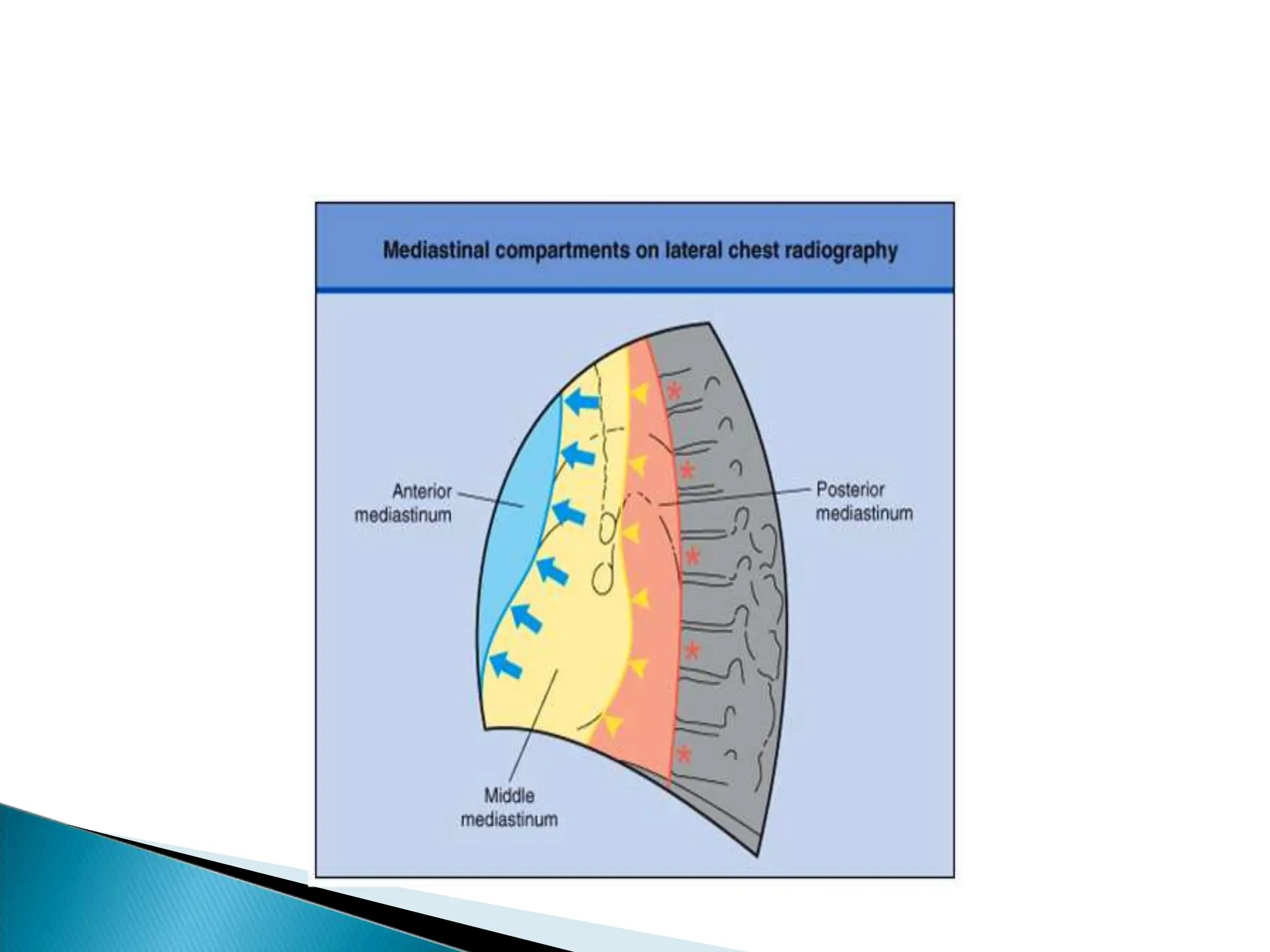 MEDIASTINAL MASSES & THYMOMAS, MEDIASTINAL MASSES & THYMOMAS | PPTX