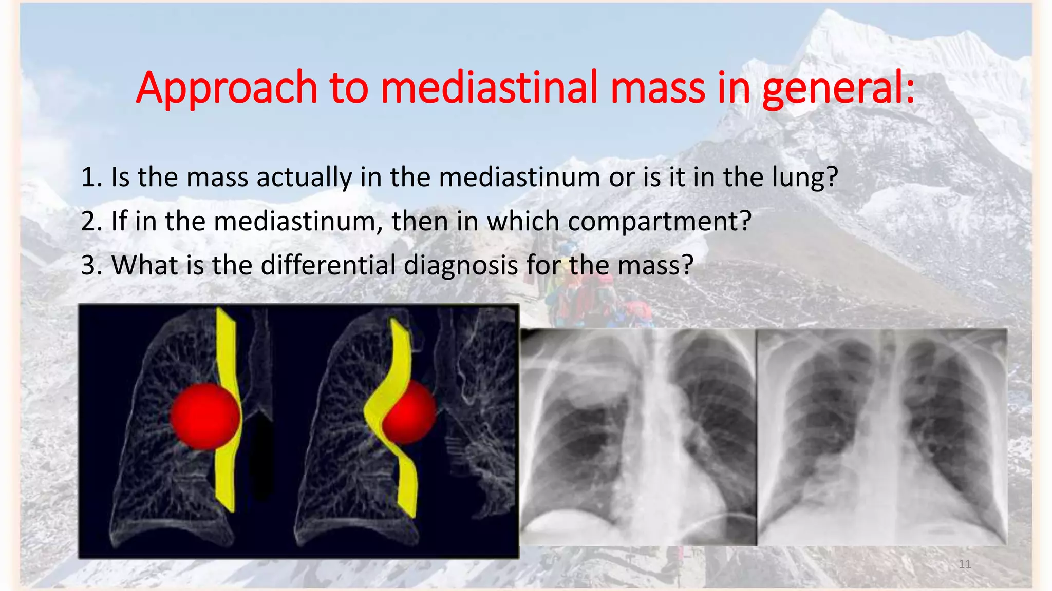 Approach to Mediastinal Mass | PPTX