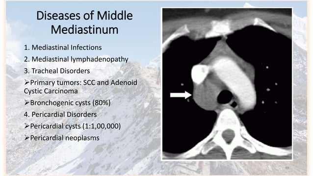 Approach to Mediastinal Mass | PPTX