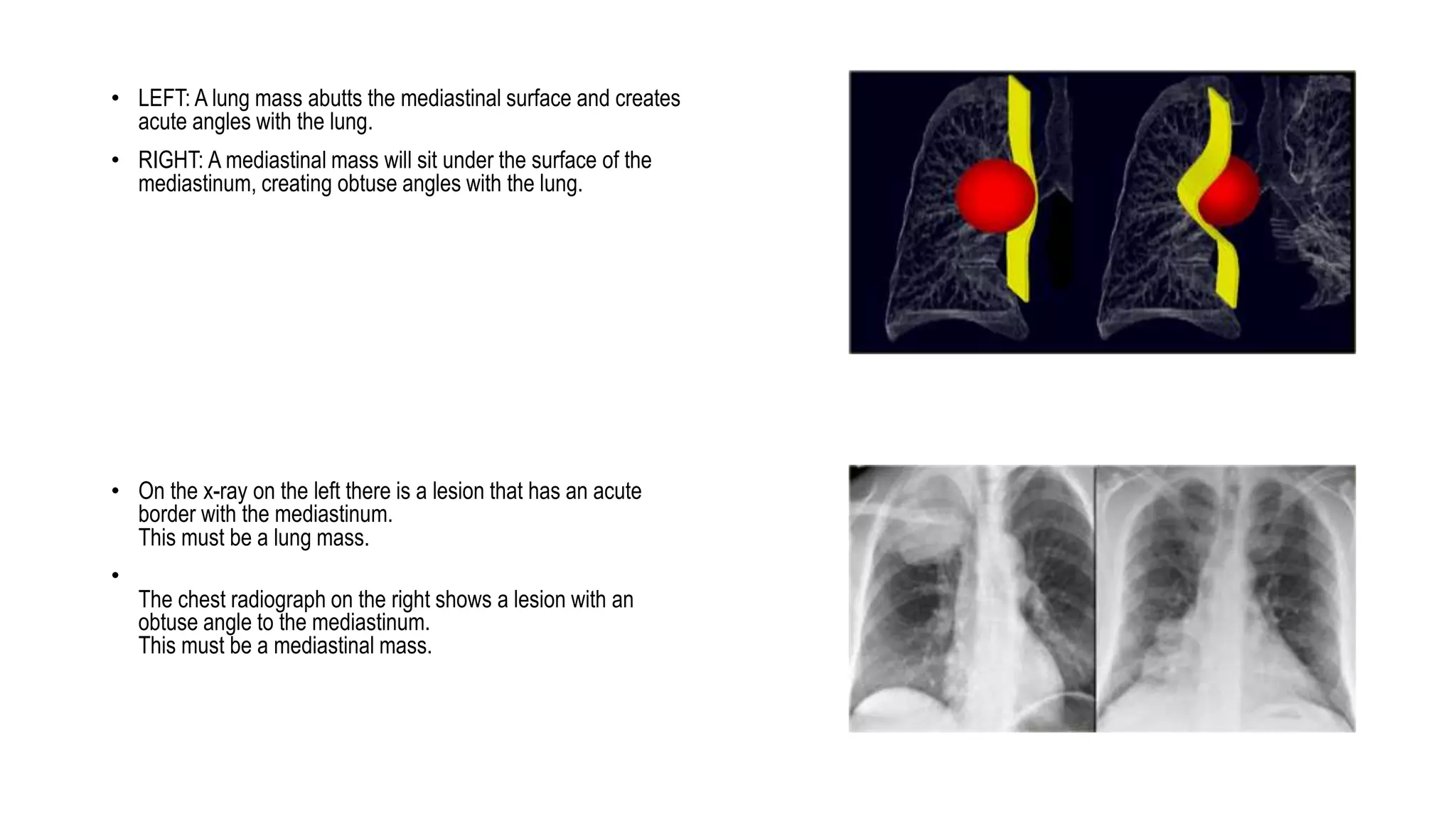 MEDIASTINAL TUMORS | PPTX