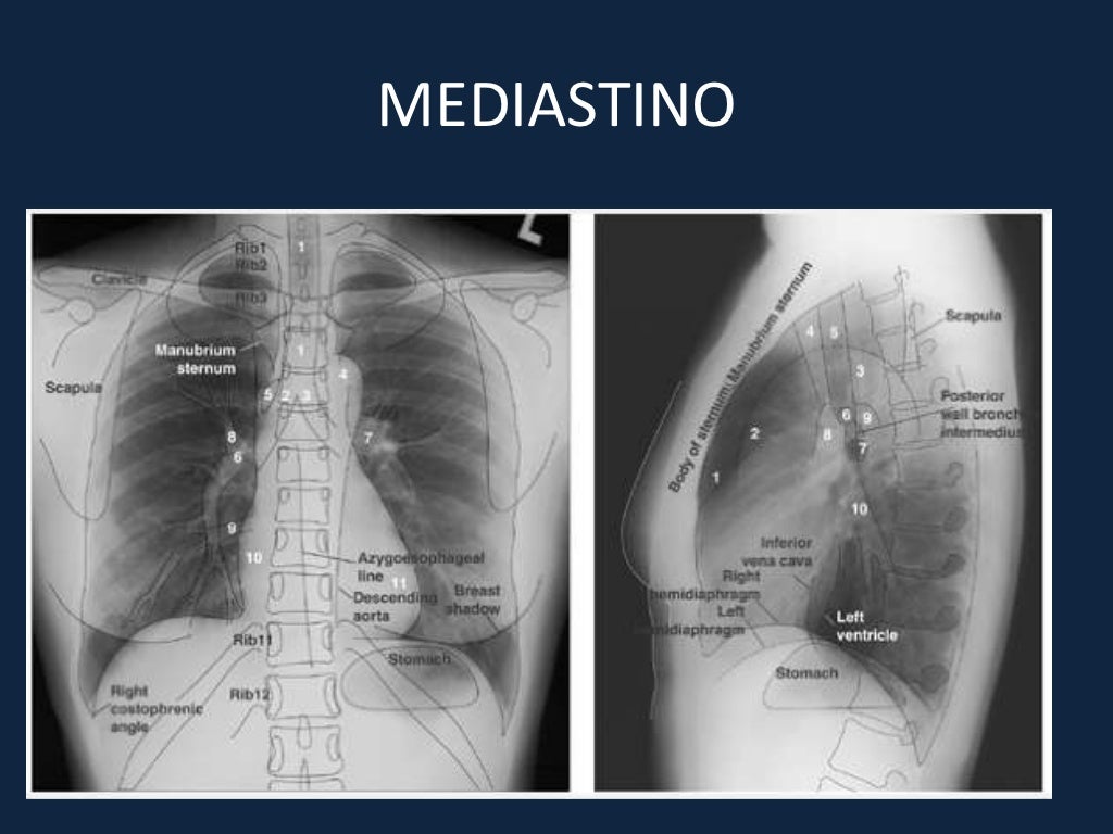 Mediastino