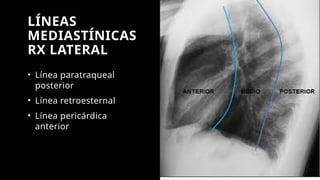 mediastino radiografia de Torax... .pptx