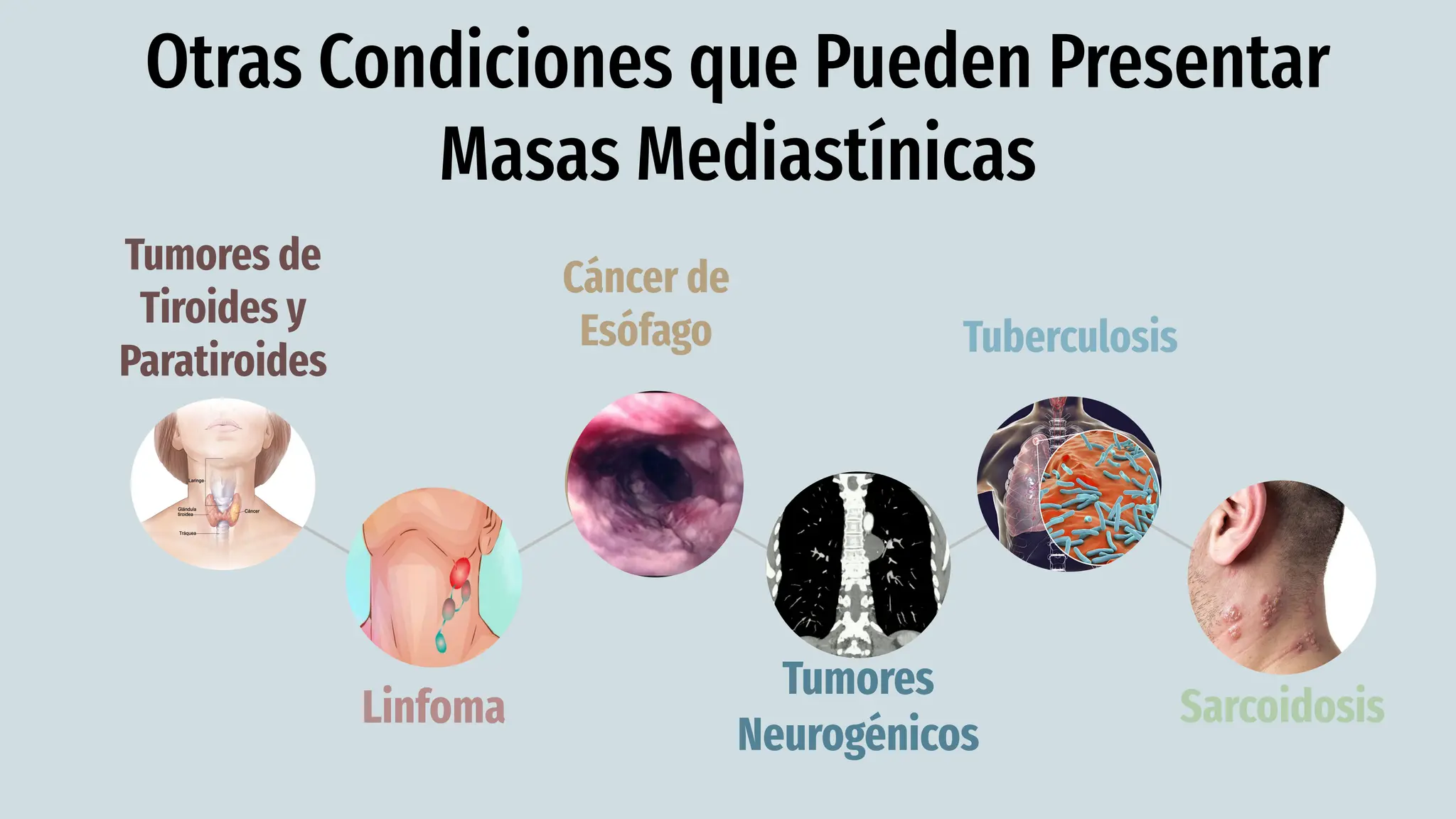 Mediastinoscopia y Cáncer de Pulmón | PDF