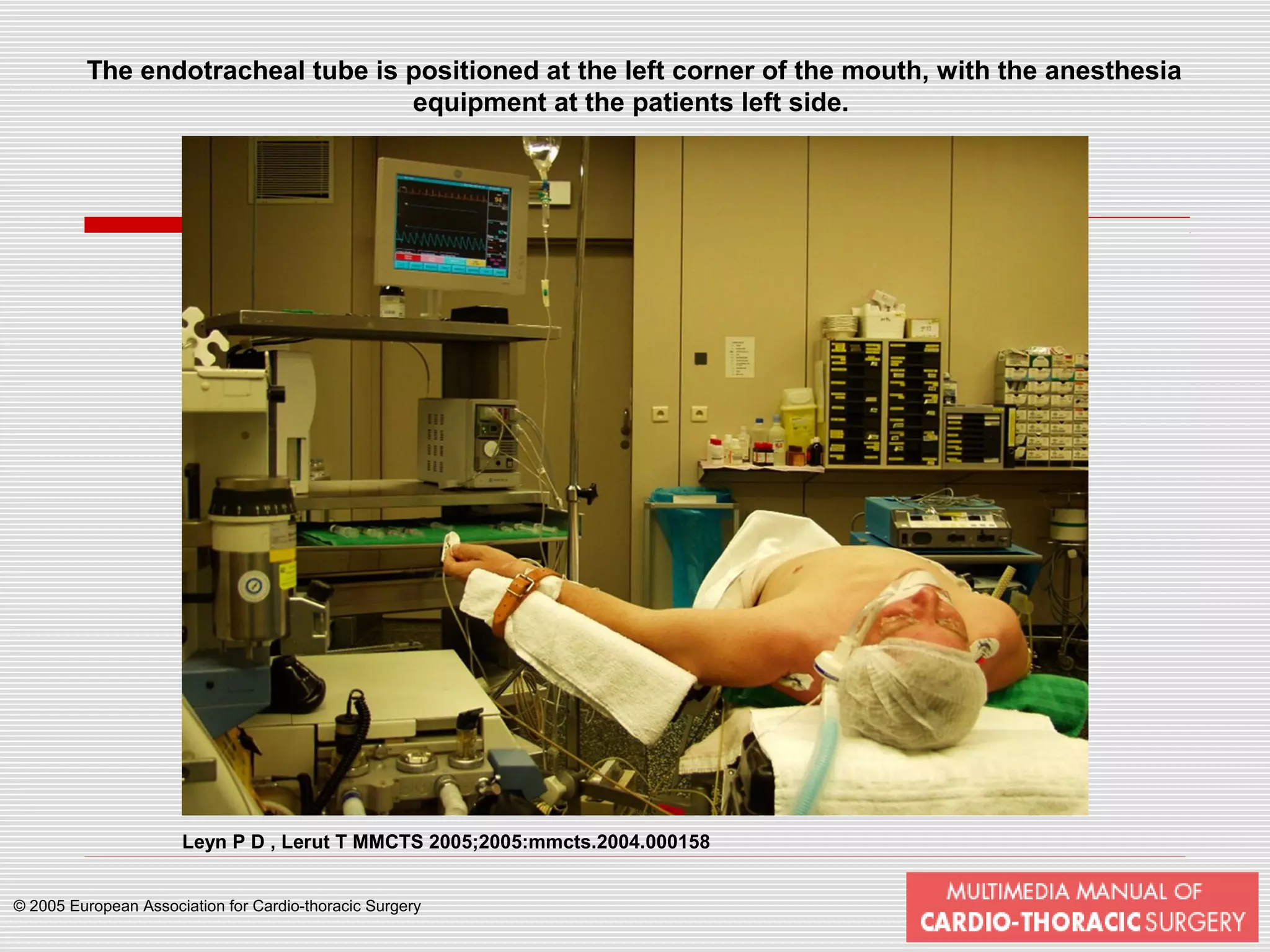 Mediastinoscopy & mediastinotomy indications & techniques | PPT