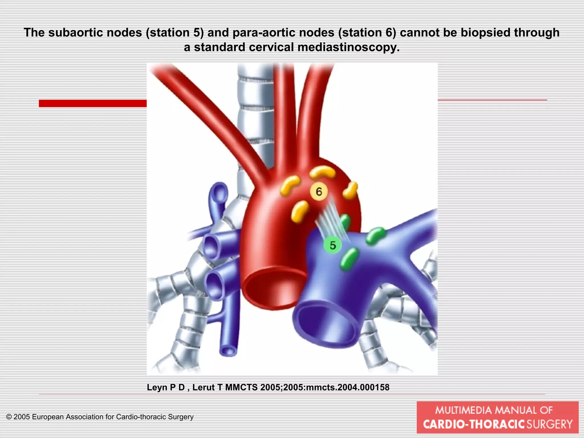 Mediastinoscopy & mediastinotomy indications & techniques | PPT