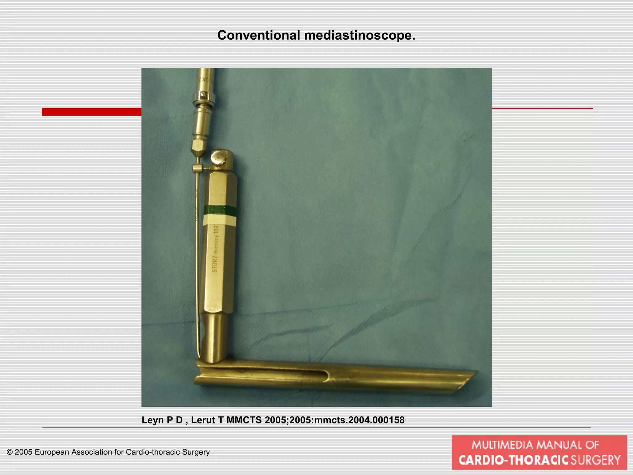 Mediastinoscopy & mediastinotomy indications & techniques | PPT