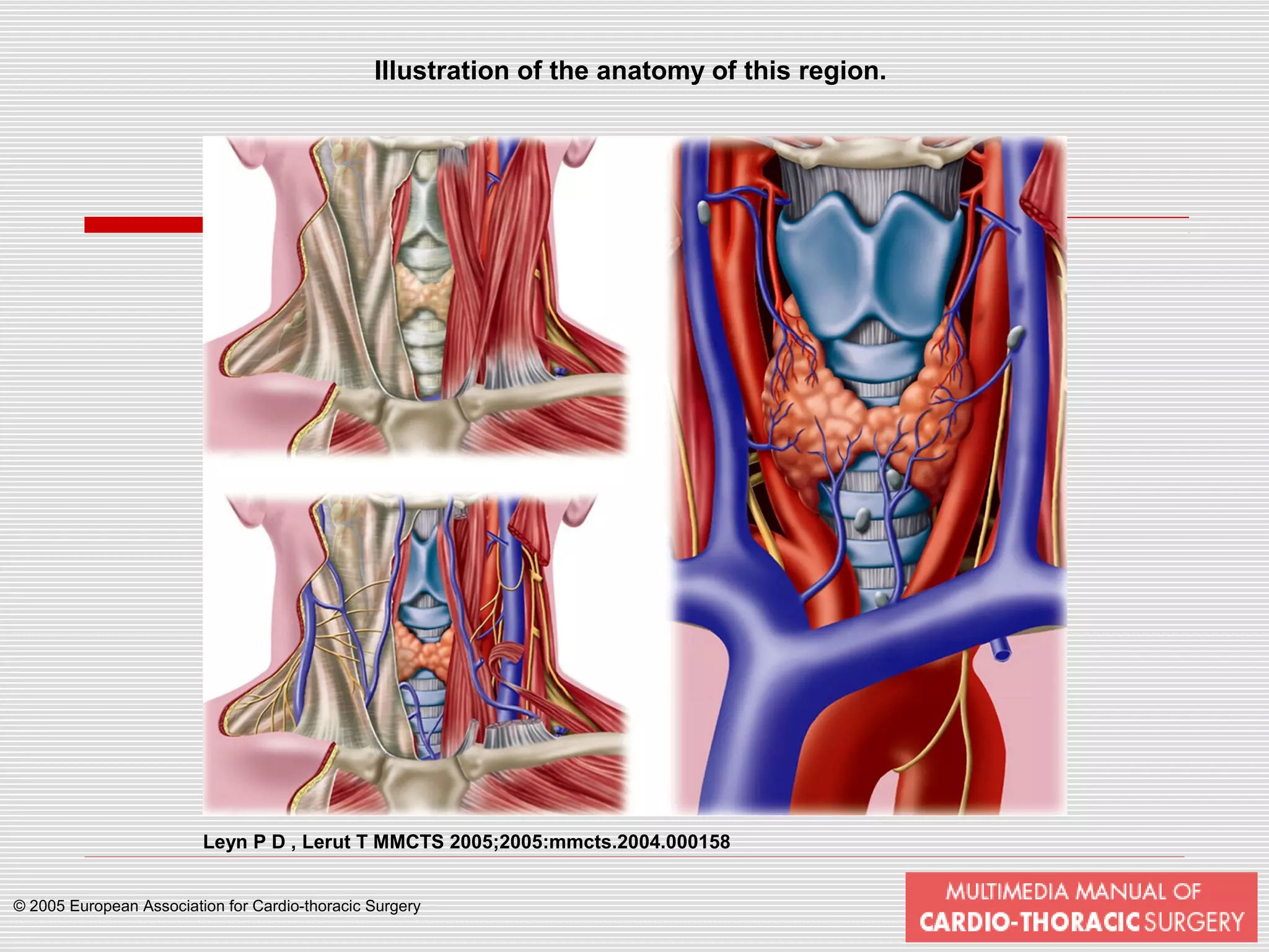 Mediastinoscopy & mediastinotomy indications & techniques | PPT