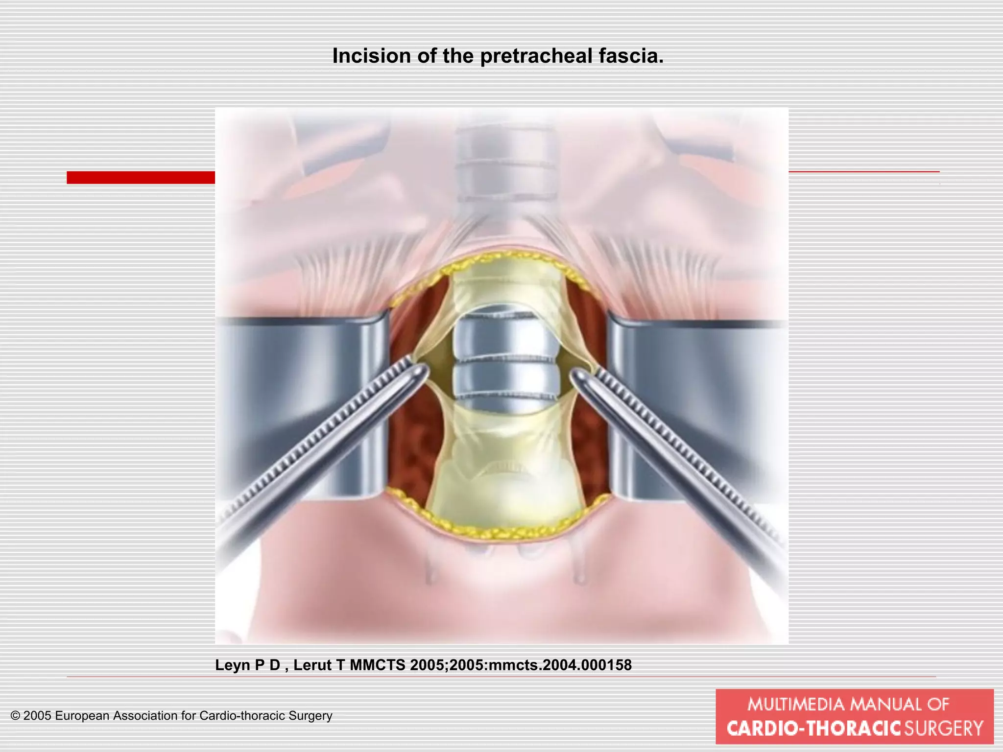 Mediastinoscopy & mediastinotomy indications & techniques | PPT