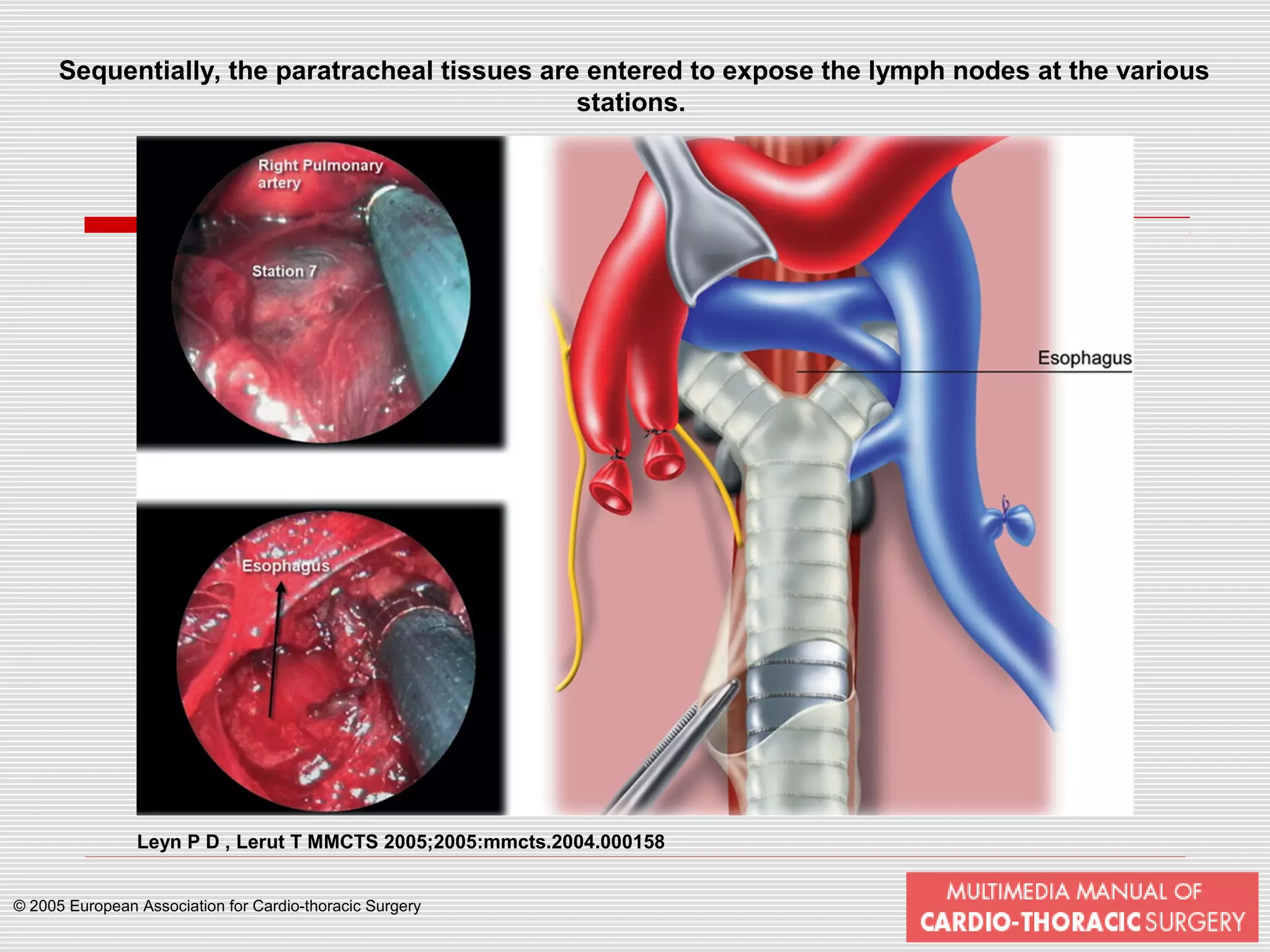 Mediastinoscopy & mediastinotomy indications & techniques | PPT