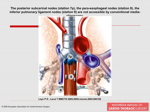 Mediastinoscopy & mediastinotomy indications & techniques | PPT | Lung ...