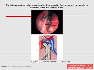 Mediastinoscopy & mediastinotomy indications & techniques | PPT