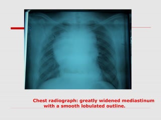 Mediastinoscopy & mediastinotomy indications & techniques | PPT