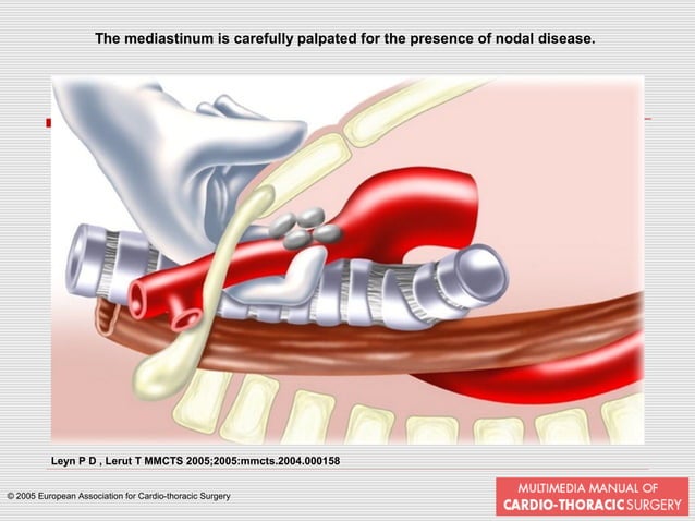 Mediastinoscopy & mediastinotomy indications & techniques