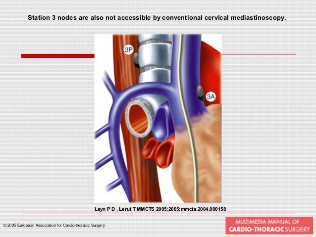 Mediastinoscopy & mediastinotomy indications & techniques
