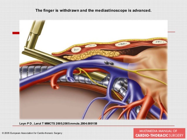 Mediastinoscopy & mediastinotomy indications & techniques