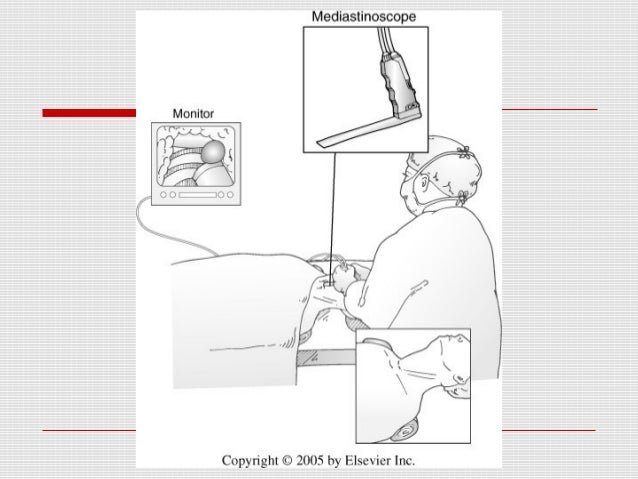 Mediastinoscopy & mediastinotomy indications & techniques