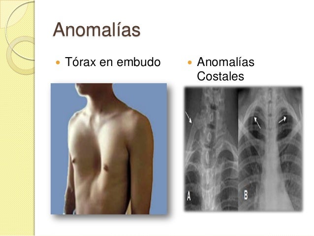 Mediastino tutoria pptx (1)
