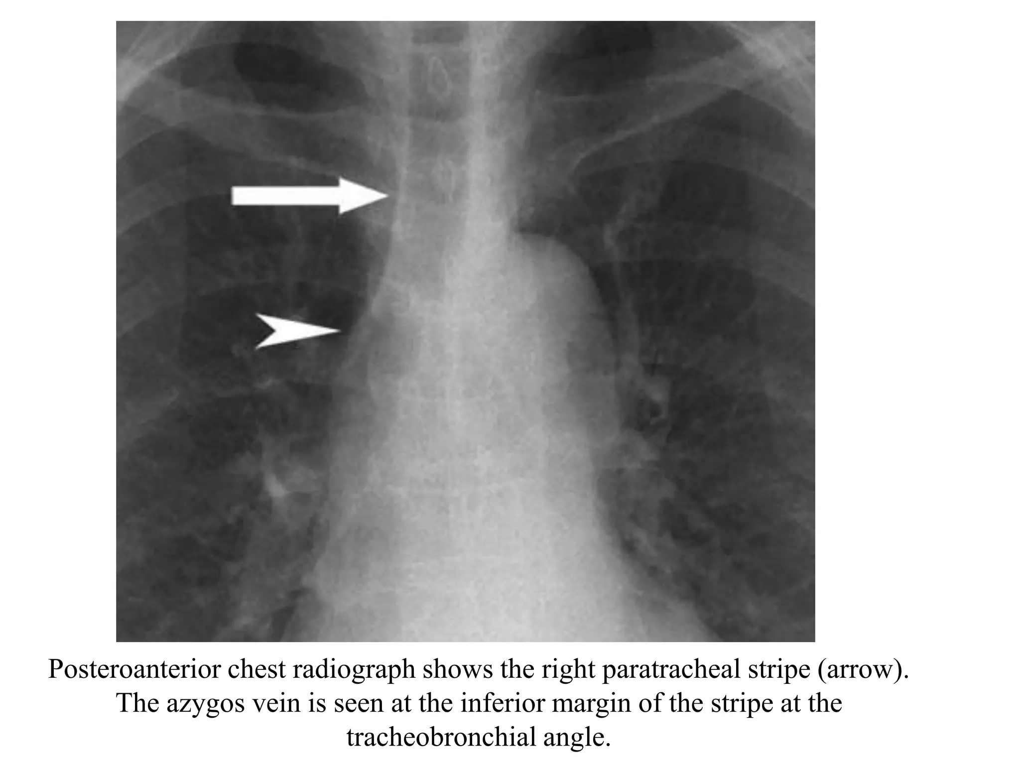 Mediastinum-RADIOLOGY | PPTX