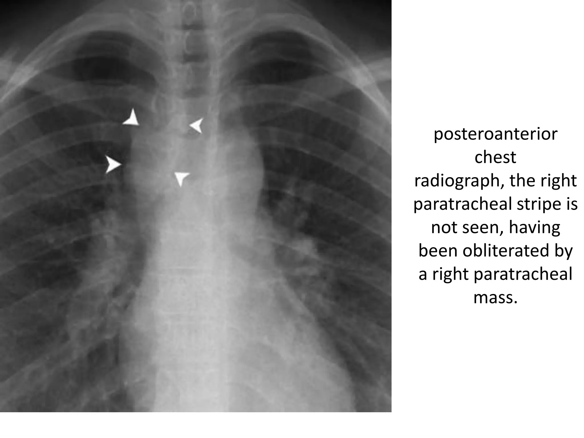 Mediastinum-RADIOLOGY | PPTX