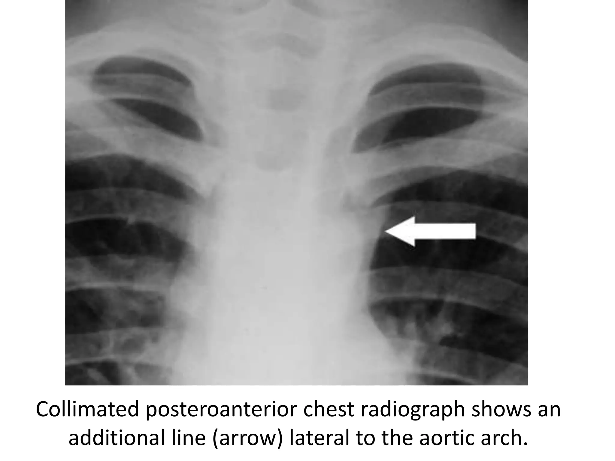 Mediastinum-RADIOLOGY | PPTX