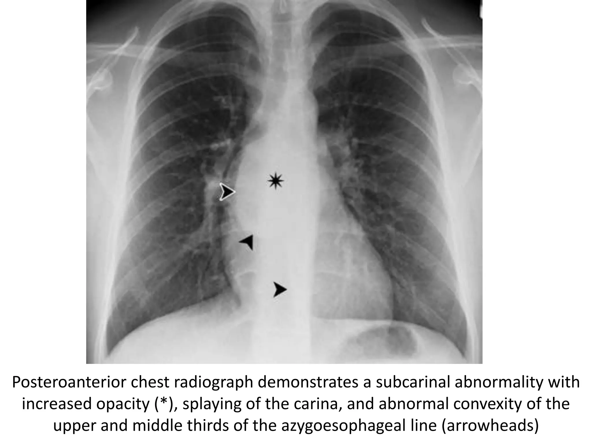 Mediastinum-RADIOLOGY | PPTX
