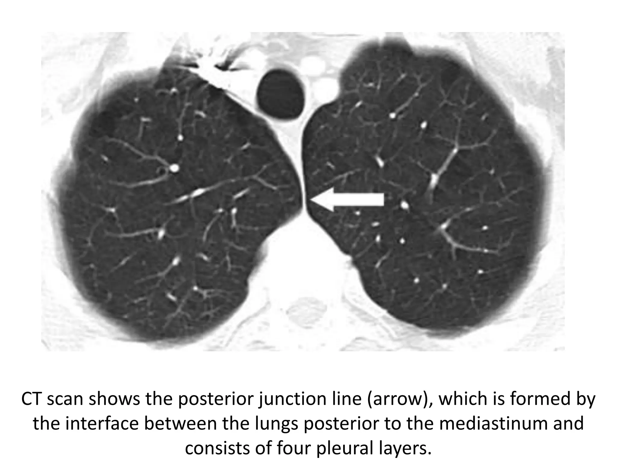 Mediastinum-RADIOLOGY | PPTX