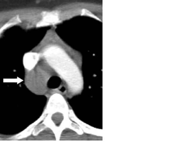 Mediastinum-RADIOLOGY | PPTX