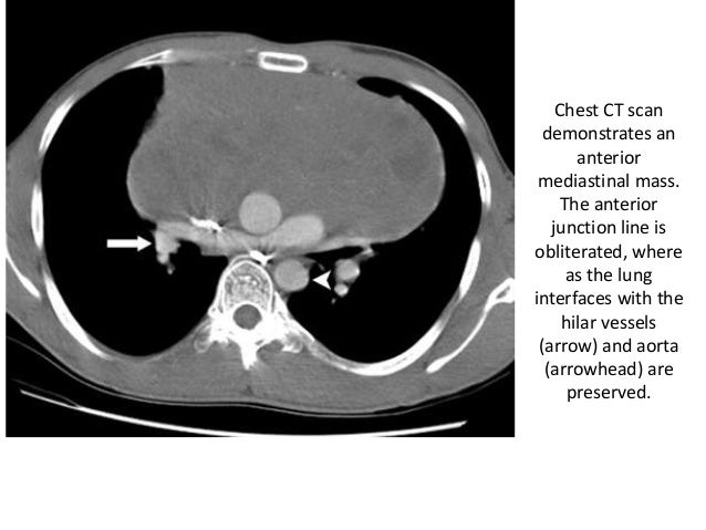 Mediastinum-RADIOLOGY
