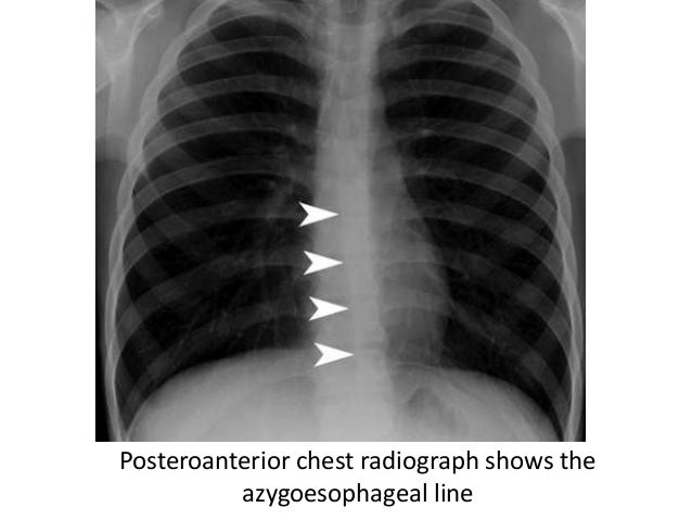 Mediastinum-RADIOLOGY