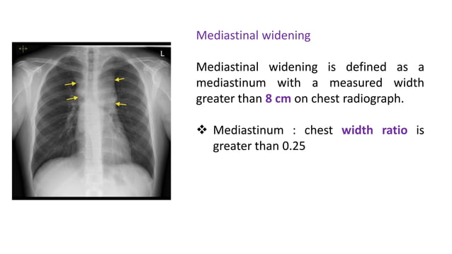 Mediastinum | PPT