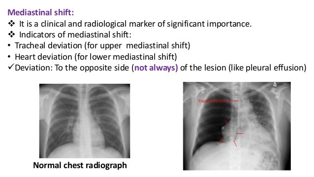 Mediastinum