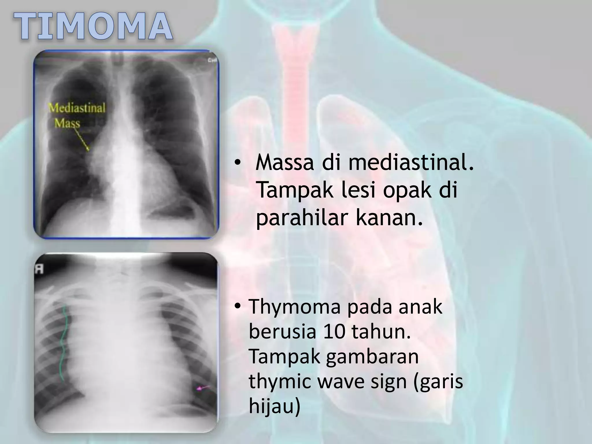 Tumor Mediastinum | PPTX