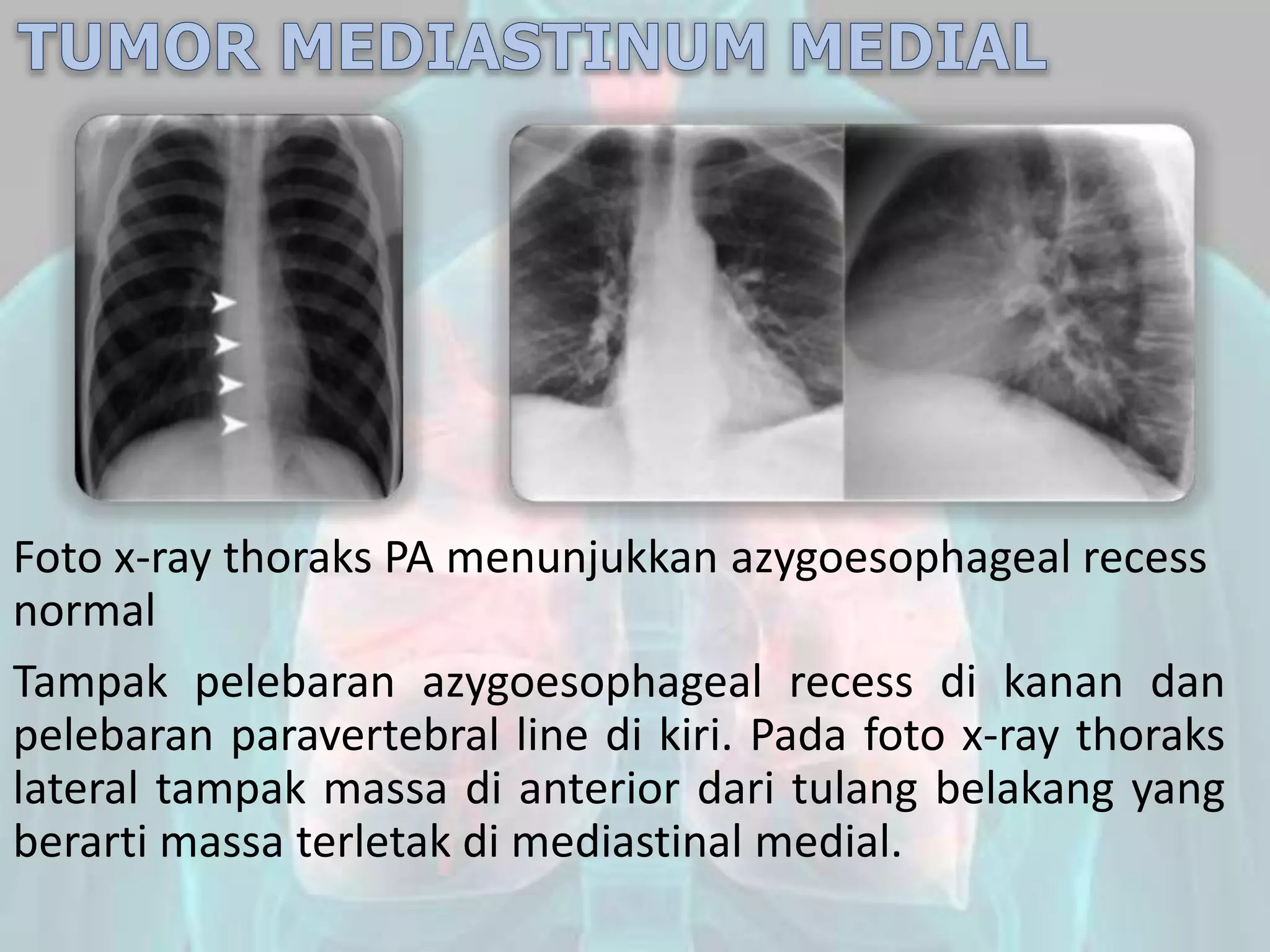 Tumor Mediastinum | PPTX