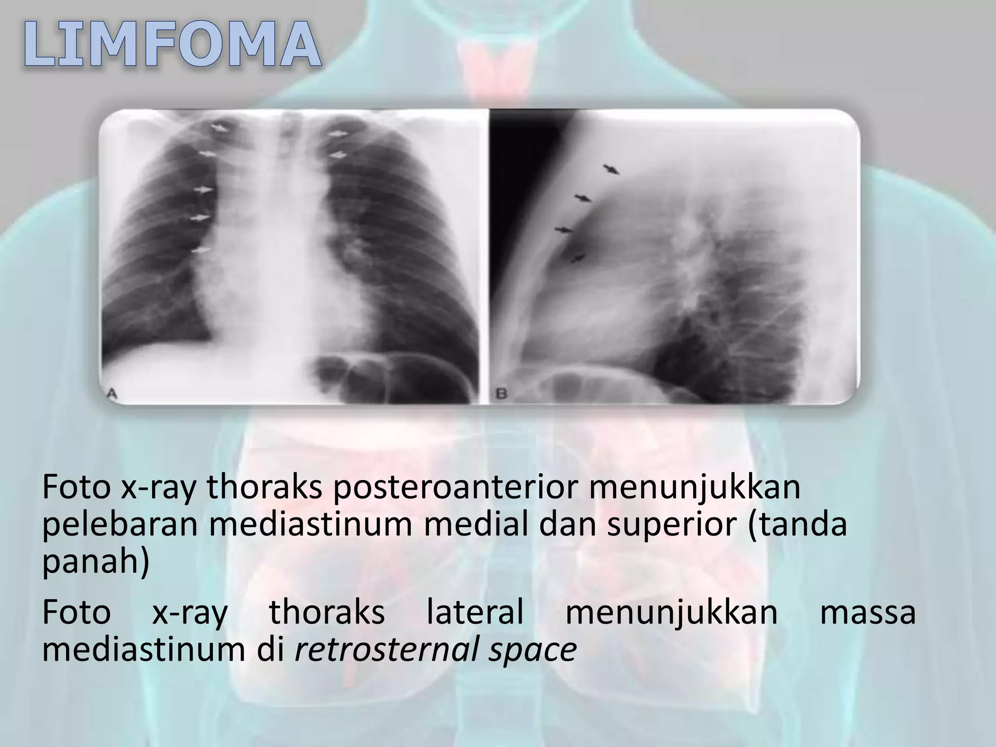 Tumor Mediastinum | PPTX
