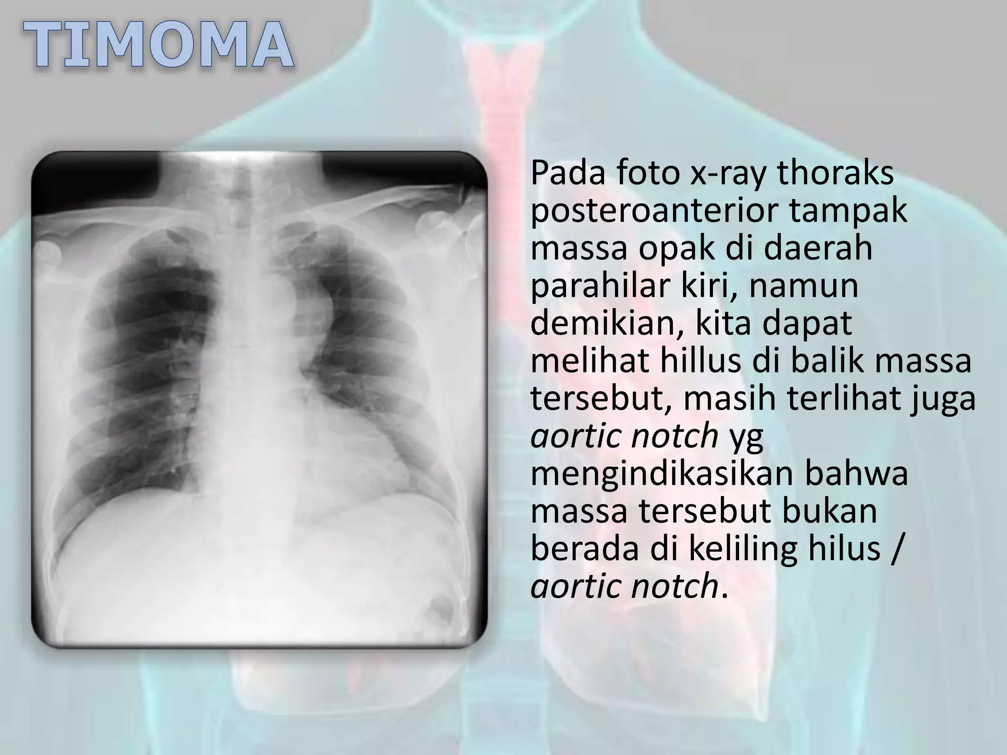 Tumor Mediastinum | PPTX