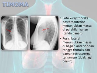 Tumor Mediastinum | PPTX