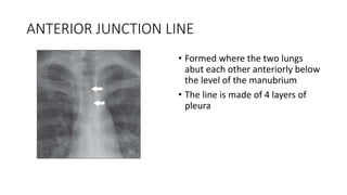 MEDIASTINUM.pptx