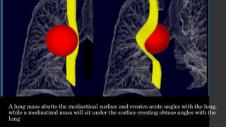 Anatomy & Radiology of the Mediastinum.pptx
