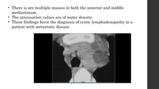 Anatomy & Radiology of the Mediastinum.pptx