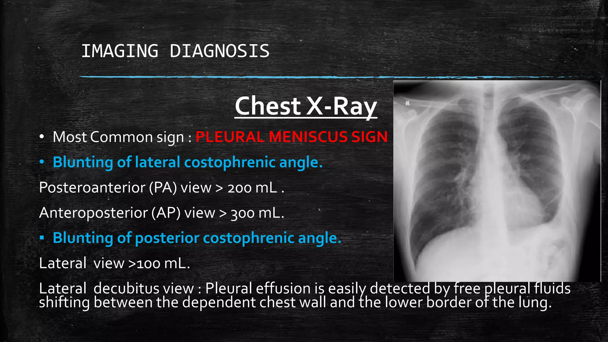 Mediastinum and Pleura Radiology MBBS final semester class | PPTX