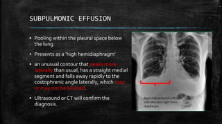 Mediastinum and Pleura Radiology MBBS final semester class | PPTX