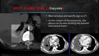 Mediastinum and Pleura Radiology MBBS final semester class | PPTX