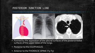 Mediastinum and Pleura Radiology MBBS final semester class | PPTX