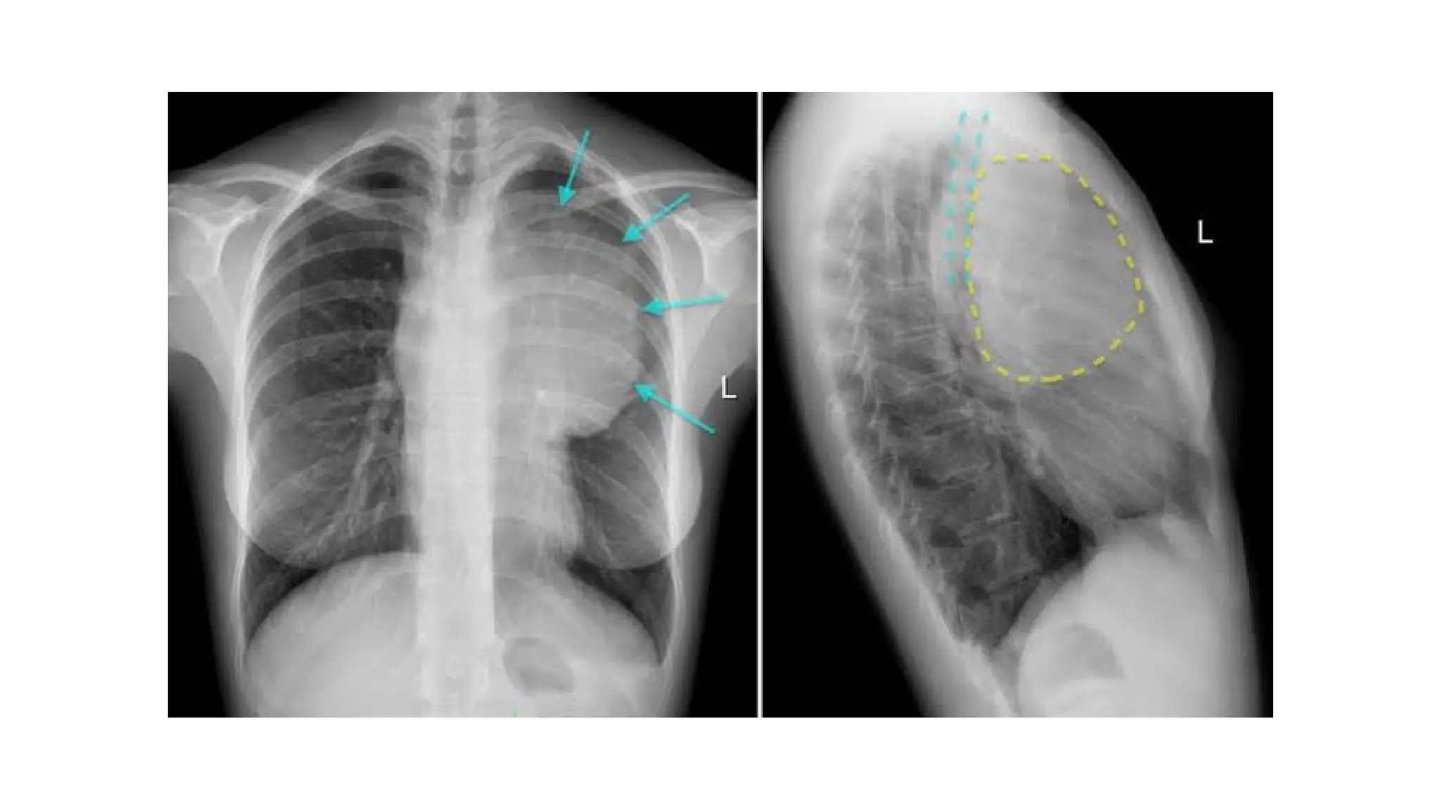 Mediastinum an Introduction, basics in Surgical Anatomy, Diseases and ...