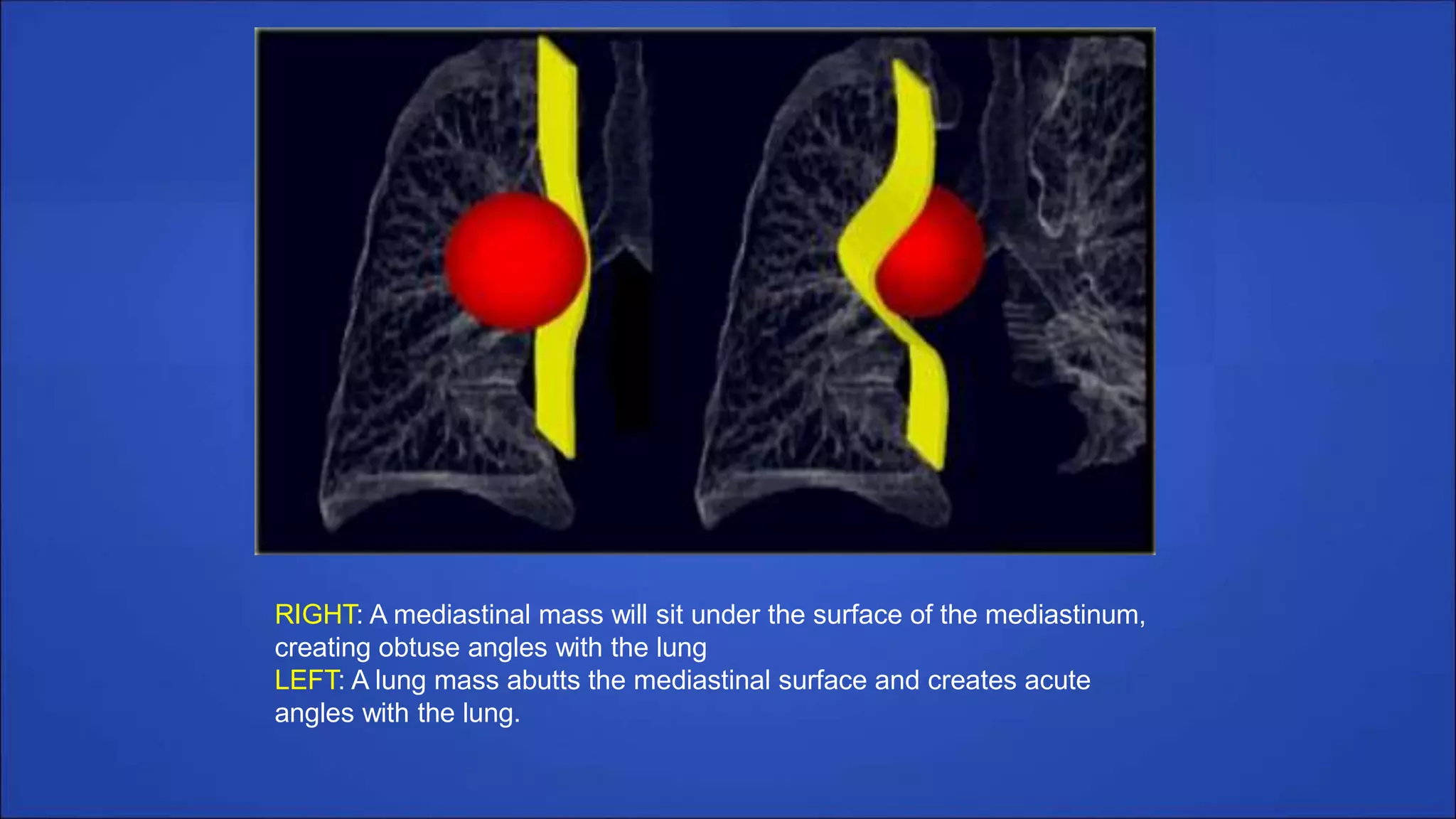 MEDIASTINUM TUMOUR.pptx
