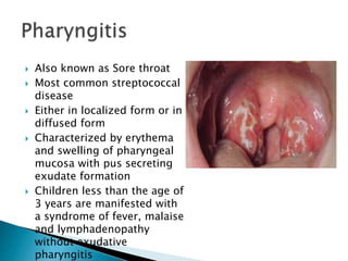 Streptococcus Pyogenes Throat