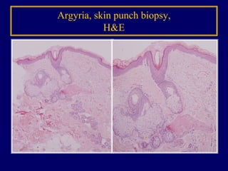 Argyria Histology
