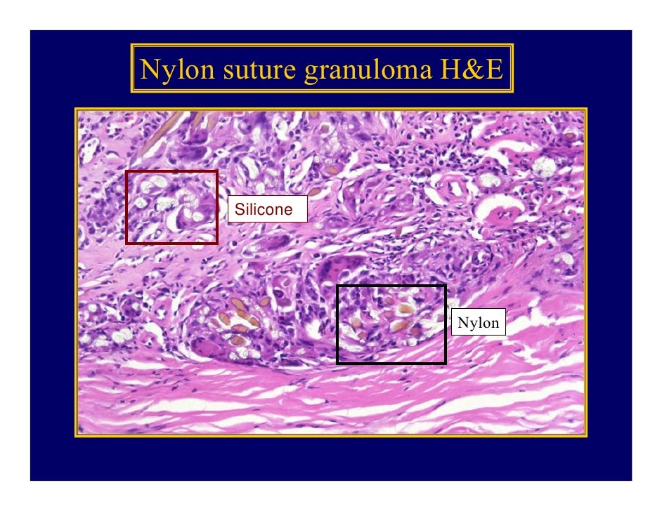 Medical Foreign Bodies