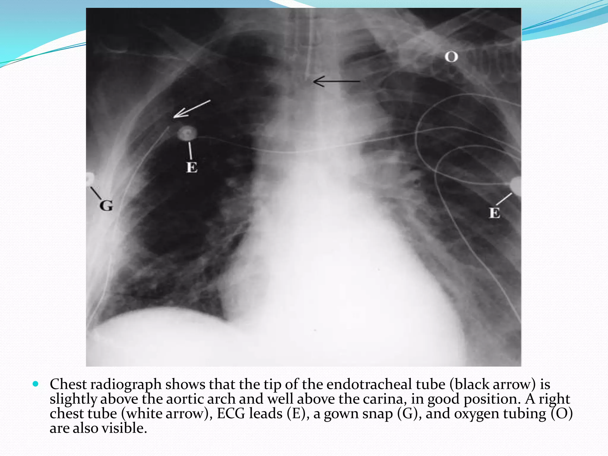 Medical devices on the chest x ray | PPTX