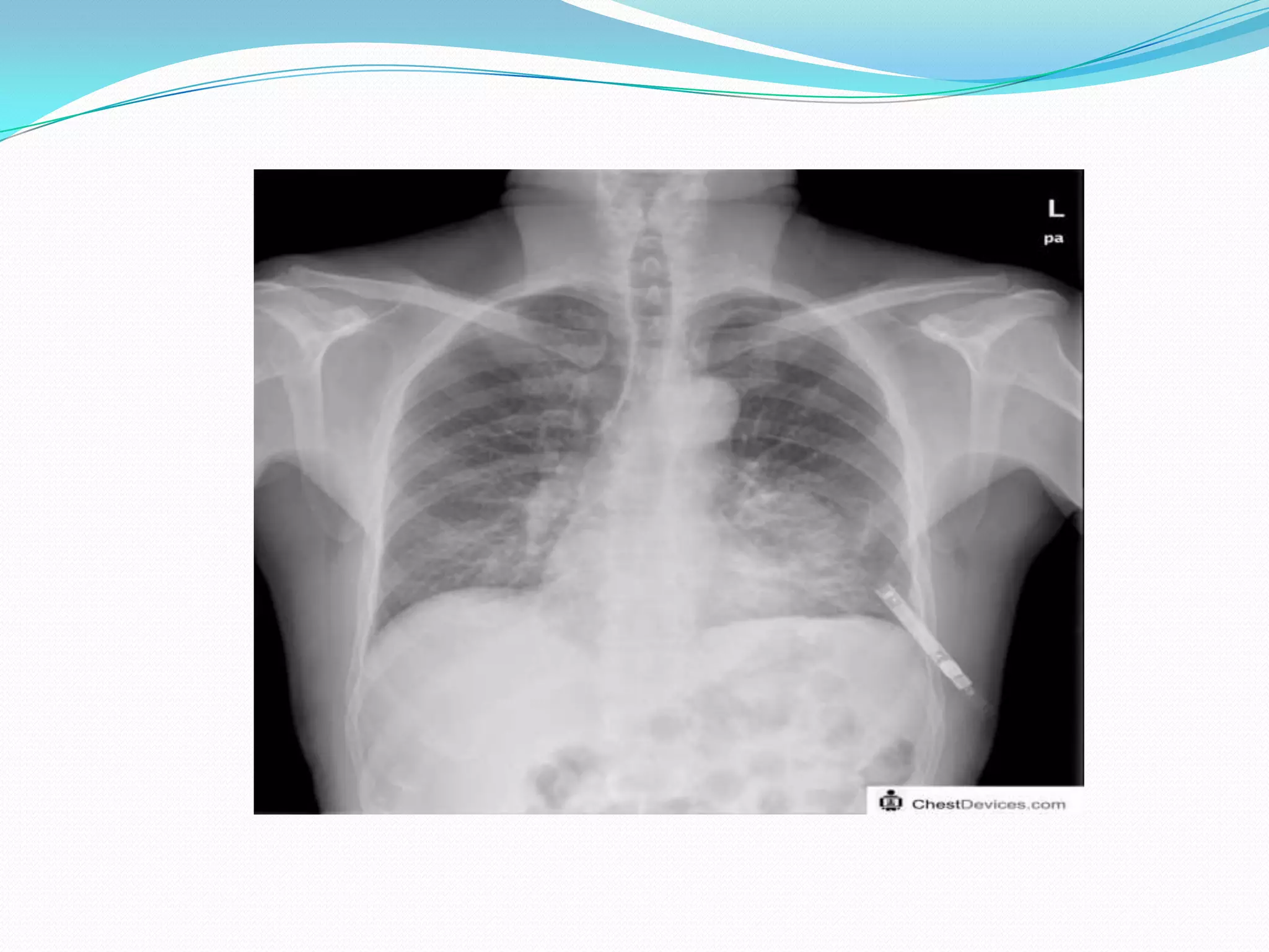 Medical devices on the chest x ray | PPTX